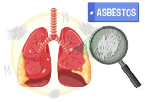 Asbestosis Symptoms - Everything You Need To Know - TOTAL